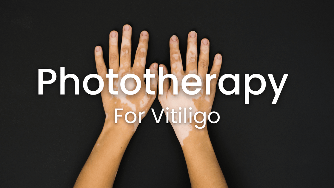 Phototherapy for Vitiligo – Care Lamps